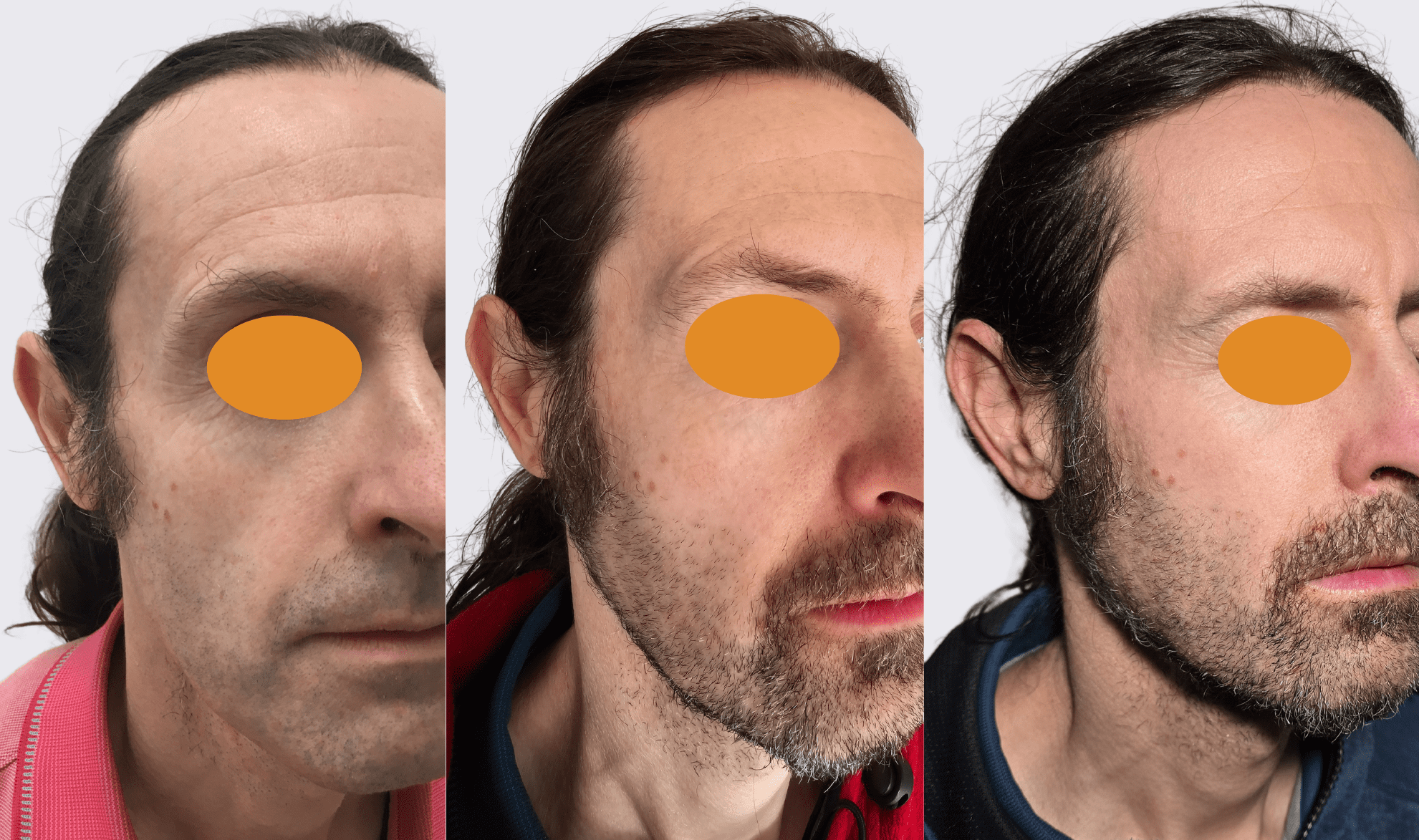 Platelet Rich Fibrin (PRF)/Ez Gel Treatment Balwyn - JJ Cosmetic Clinic